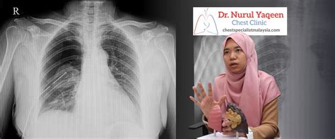 Pneumothorax Symptoms Causes And Treatment For Malaysians