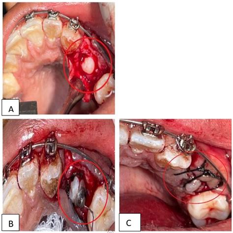 Showing Surgical Procedure Of Impacted Second Premolar A Surgical Download Scientific