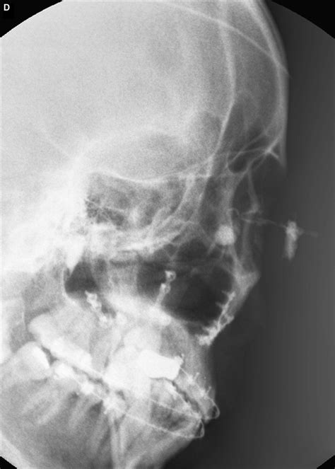 Nasolacrimal Duct Obstruction After Maxillary Orthognathic Surgery