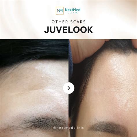 Juvelook Malaysia Nextmed Clinic