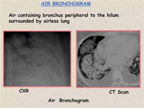 Chest Radiology Ppt
