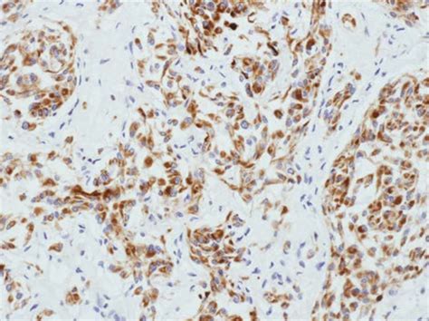 Cytokeratin Ae1 Ae3 Perinuclear And Citoplasmatic Staining Ck
