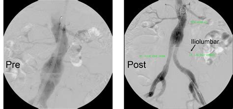 Type Ii Endoleak Iliolumbar Access A Surgeons Notes