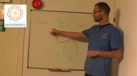 Correcting Cross Bite Using Orthodontic Elastics By Dr Mike Mew