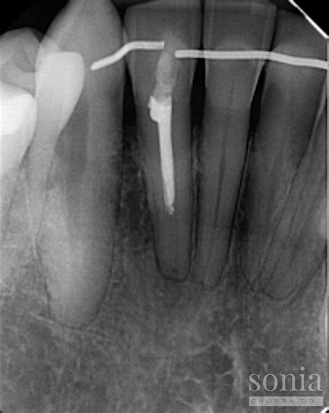 Tooth Story A Case Of Severe Calcification Sonia Chopra Dds