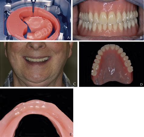 A Comparison Of Two Digital Techniques For The Fabrication Of Complete