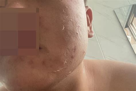 日光性皮炎面部症状图片