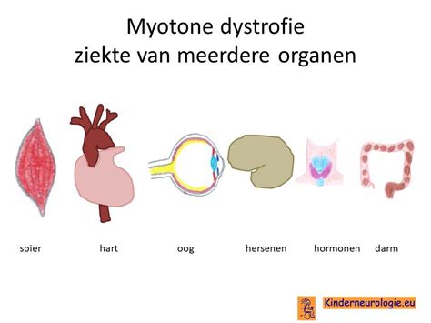 Myotone Dystrofie Kinderneurologie