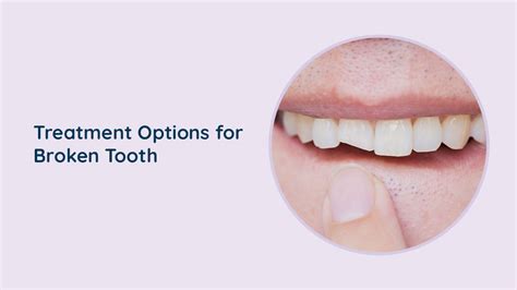 Can A Broken Tooth Be Saved What You Need To Know