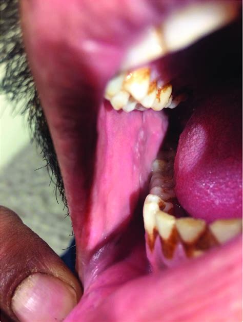 White Plaques Showing Reticular Branching Were On The Buccal Mucosa