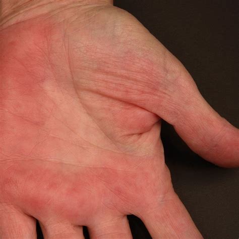 Erythema Hands