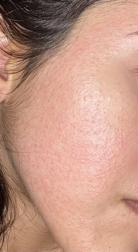 Mild Atopic Dermatitis Face Seborrhoeic Dermatitis Symptoms Causes