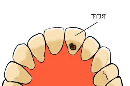 下门牙内侧掉了一块图片妙手医生