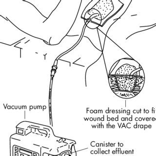 Summary Of Fistula Characteristics And Effect Of Vac Treatment