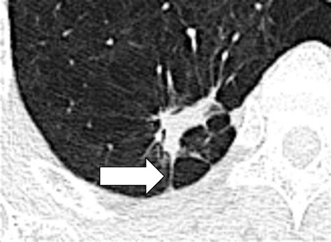 Fleischner Society Glossary Of Terms For Thoracic Imaging Pubmed
