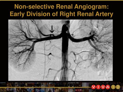 Ppt Techniques Of Renal Arteriography Powerpoint Presentation Free