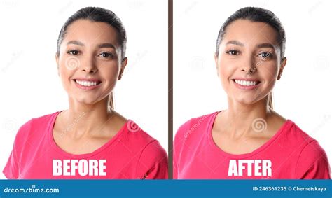 Woman Before And After Gingivoplasty Procedure On White Background