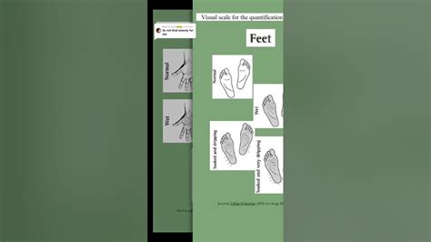 Visual Scale For The Quantification Of Hyperhidrosis To Measure Or