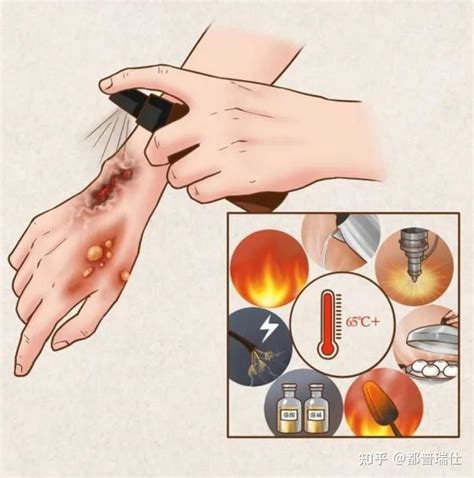 烧伤瘢痕康复压力衣的研究现状与展望 知乎