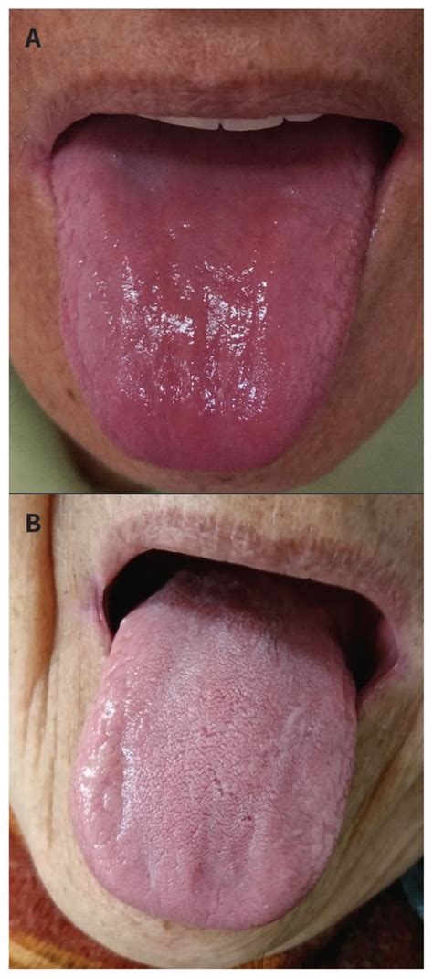 Iron Deficiency Anemia Tongue