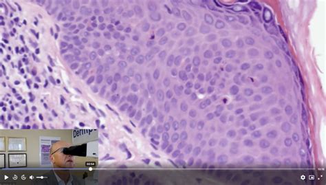 Unusual Interface Dermatitis Without Interface Inflammation Dermpedia