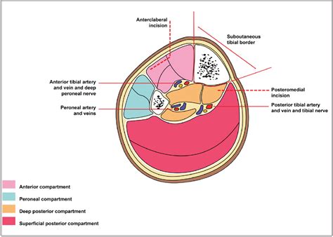 Acute Compartment Syndrome And Fasciotomy Defence Medical Command