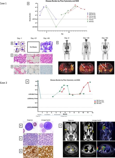 Crlf2 Rearranged B Cell All With Extramedullary Lineage Switch To Aml