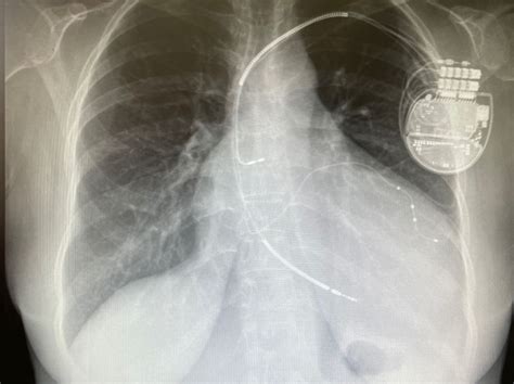 Waleed Alqassabi On Linkedin 35 Yr F With Crt Device Came To The