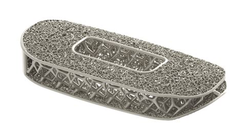 Nuvasive Prints 3d Implants For The Spine 3dnatives