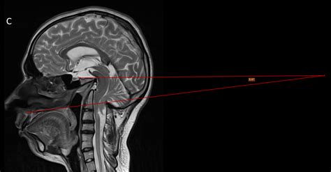 Platybasia Angle