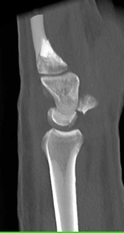 Fracturedislocation Of The Carpal Bones Musculoskeletal Radiology
