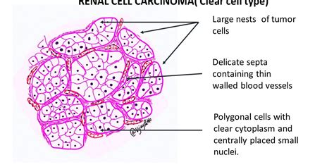 Renal Cell Carcinoma Clear Cell Type Pathology Made Simple