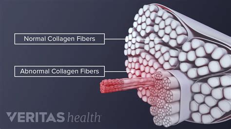 Surgery For Wrist Tendonitis