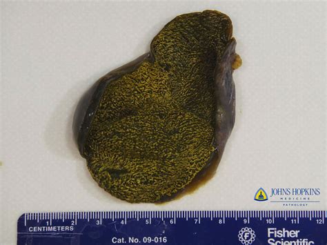 Gallbladder Photo My Xxx Hot Girl