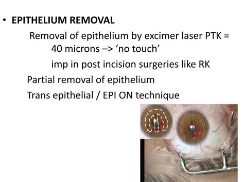 Corneal Collagen Cross Linking Pptx