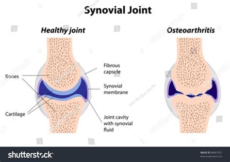 Bone Spur Over 335 Royalty Free Licensable Stock Vectors And Vector Art