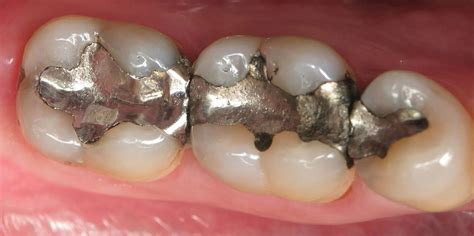 Amalgama Dental Sustitución Por Resinas Y Consideraciones Sobre Su Uso