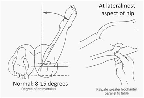 Not All Hips Are Created The Same Hip Anteversion And Retroversion Considerations Functional