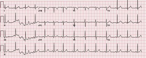Dr Smiths Ecg Blog Persistent Juvenile T Wave Pattern