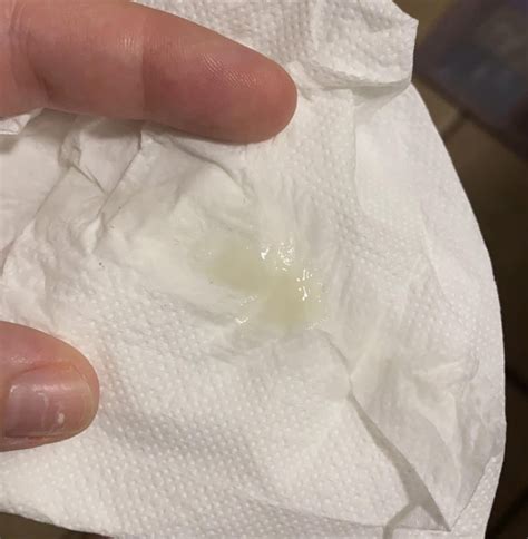 Jelly Like Discharge Early Pregnancy Cervix Uterine Or Cervical