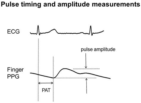 Innovative Multi Site Photoplethysmography Analysis For Quantifying