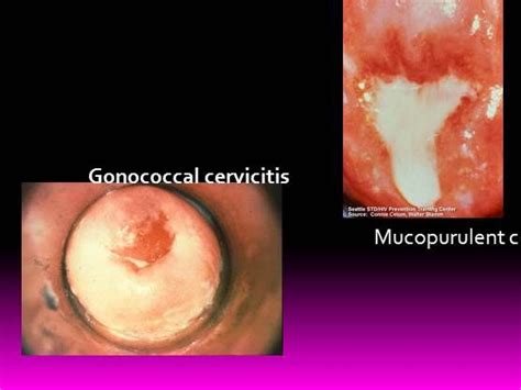 Cervicitis Cdc 2006