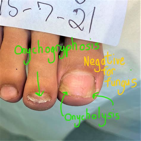 Onycholysis Toenail