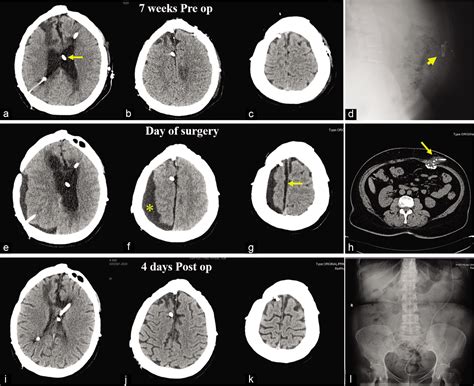 Surgical Neurology International