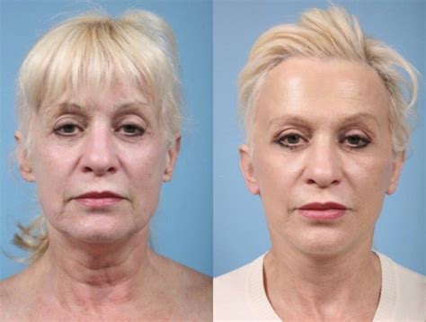Ozempic Face Before And After Real Transformations And Tips To
