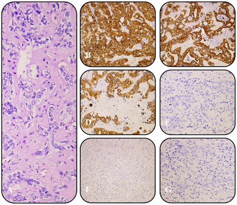 Molecular And Pathological Heterogeneity Of Synchronous Small And Large