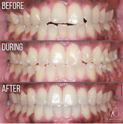 Open Bite Cause And Treatment Options