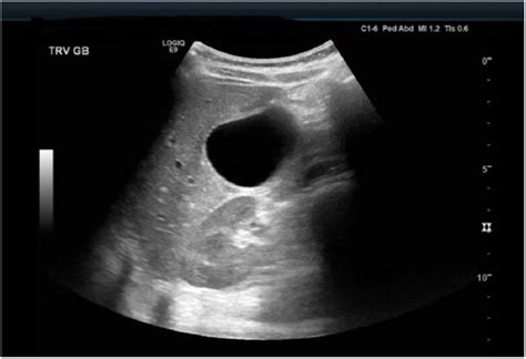 Gallbladder Ultrasound Transverse