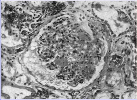 Glomerulitis With Subcapsular Exudates Dystrophic Alterations Of The