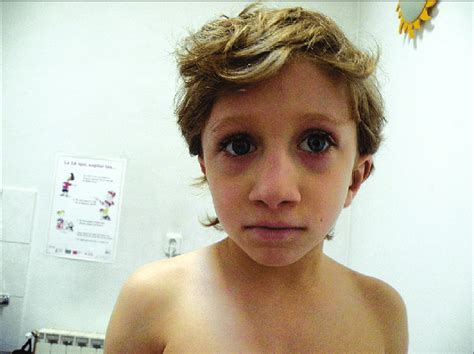 Frontal View Of The Patients Face Showing Dysmorphic Facial Features